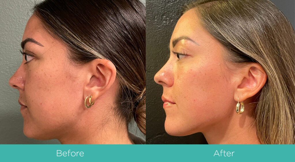 HA Fillers - Tara Brown MD